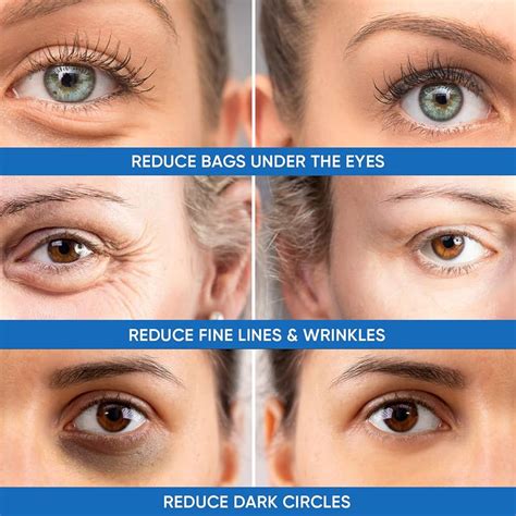 Bags Under Eyes Laser Surgery For Under Eye Bags All You Need To Know