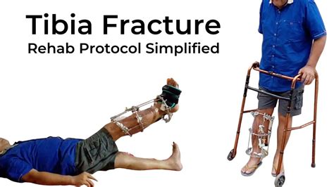 Broken Tib Fib External Fixator On