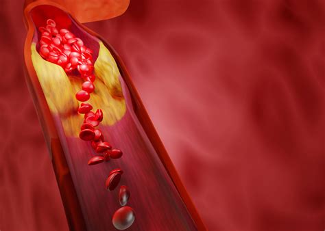 Understanding Hyperlipidemia Causes Symptoms And Treatment Options