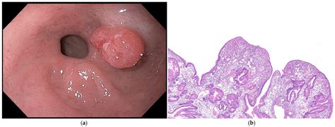 Sessile Polyp