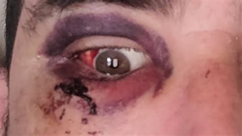 Auckland Man Suffers Broken Eye Socket In Train Assault