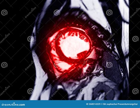 Mri Heart Or Cardiac Mri In Short Axis View Showing Cross Sections Of