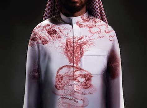 Acquired Thrombotic Thrombocytopenic Purpura Attp