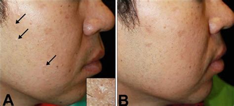 Sebaceous Hyperplasia Causes Signs Symptoms Diagnosis And Treatment