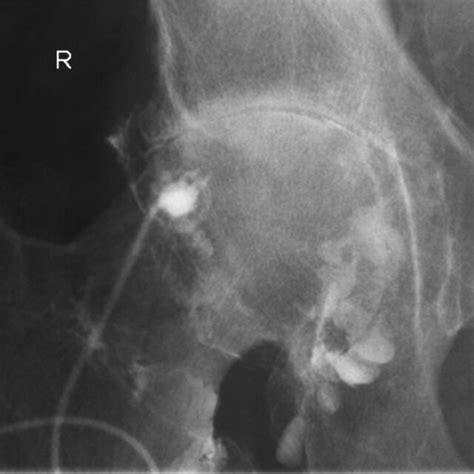 Radiographs Of Injection And Hip Arthroplasty The Anteroposterior Radiographs Of Injection And Hip Arthroplasty The Anteroposterior