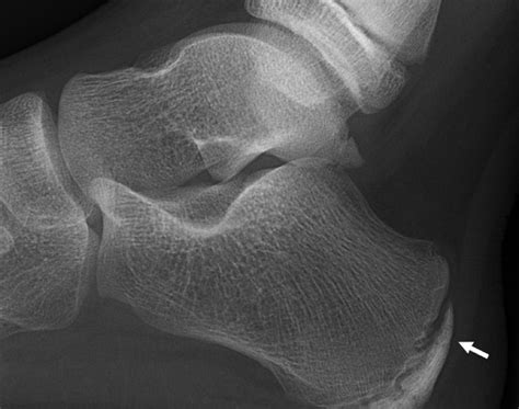 The Foot And Ankle Center Of Dallas Calcaneal Apophysitis