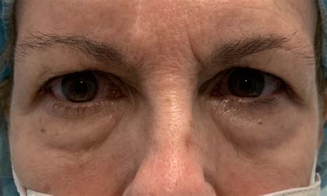 25 Eyelid Surgery Before And After Photos Dallas Plano Texas Cosmetic Reconstructive Eye Surgery