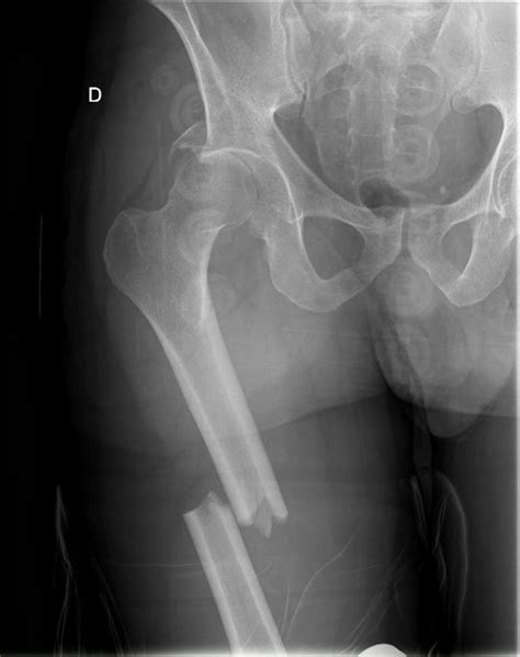 2 Fractura Diafisaria Femur Radiografia Ocronos Editorial Científico Técnica