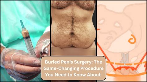 Uncovering Hidden Length Buried Penis Treatment Youtube