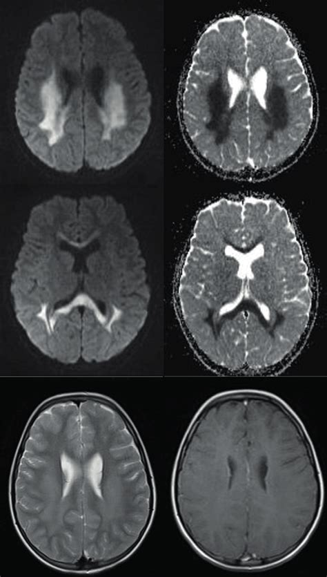 Bilateral Diffusion Restriction In Parietal White Matter Splenium And Download Scientific