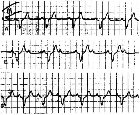 Conduction Block Rhythm Ecg At Kenton Bridges Blog