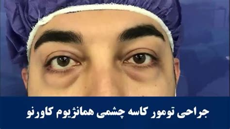 Mohammad Taher Rajabi On Linkedin Orbital Cavernous Hemangioma Removal