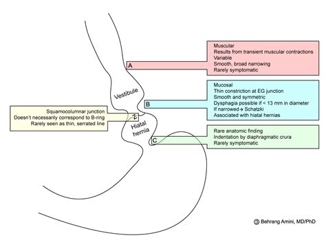 Inspirasi Terpopuler Esophagus Ring