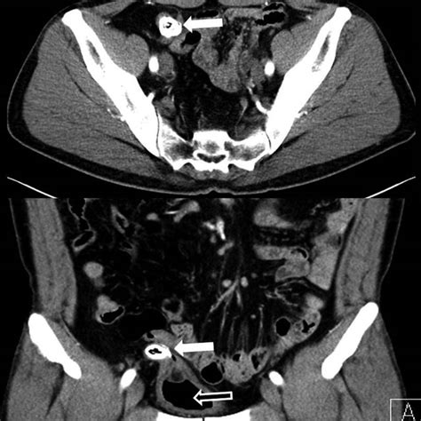 Laparoscopy Showing The Distal Tip Of The Long Appendix White Arrow
