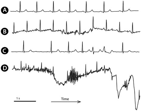 Examples Of Holter Ecg Signals Normal Sinus Rhythm A The Same Download Scientific Diagram