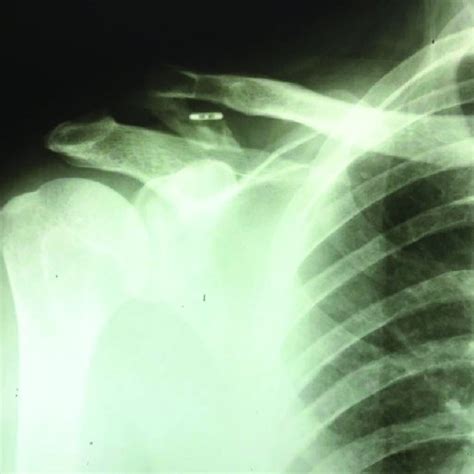 Subacromial Erosion And Osteoarthritis Of Acromioclavicular Joint Download Scientific Diagram