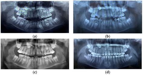 Tooth Intrusion Radiograph