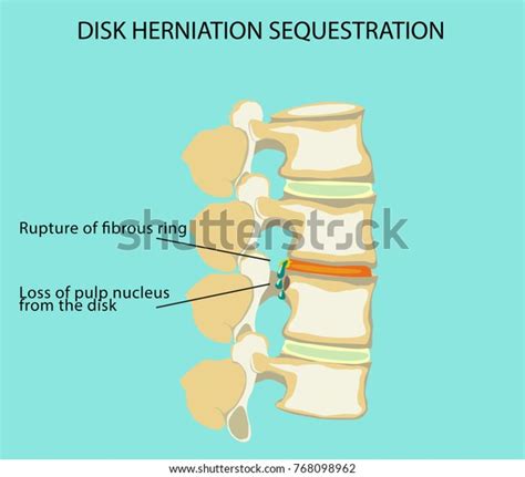 Image Sequestered Herniated Intervertebral Disc Rupture Stock
