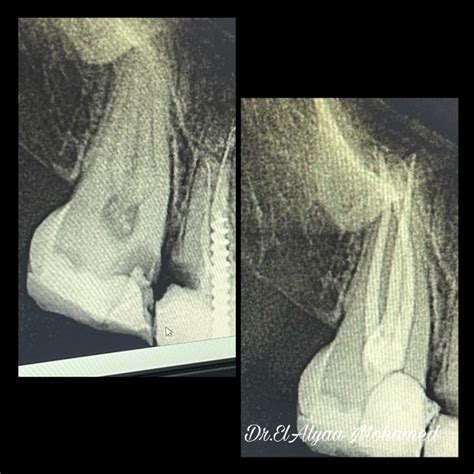 Alyaa Mohamed On Linkedin Single Visit Rct Tooth 27
