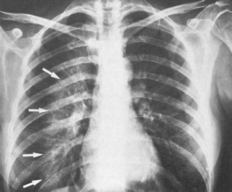 Chest X Ray Infiltrates