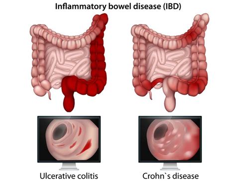 Why Clinical Remission Is Not The Goal In Ibd