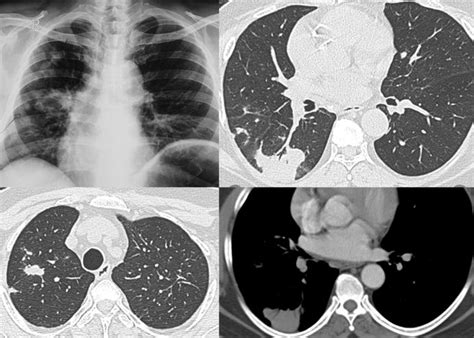 Snippet 01 Differentiating Traction Bronchiectasis From Honeycombing