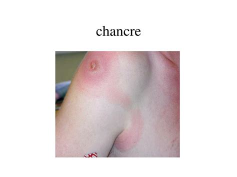 Ppt Haemoflagellates Leishmaniasis And Trypanosomiasis Powerpoint