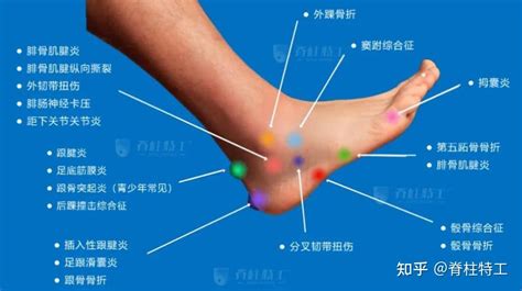 一张脚痛地图，教你自查55种疾病 知乎