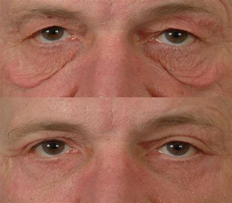 Blefaroplastika Spec Oftalmološka Ordinacija Pandl