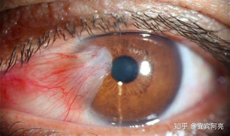 裂隙灯的检查流程和常见眼部问题总结 知乎