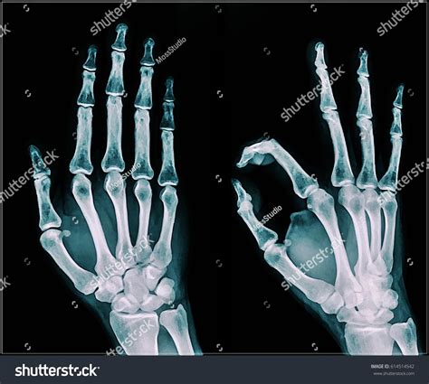 Xray Hand Ap And Oblique View Of The Involved Left Hand Distal Radius