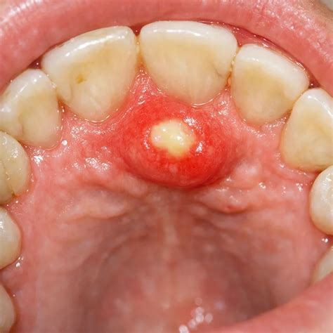 Gum Abscess Roof Of Mouth Causes Symptoms And Treatment