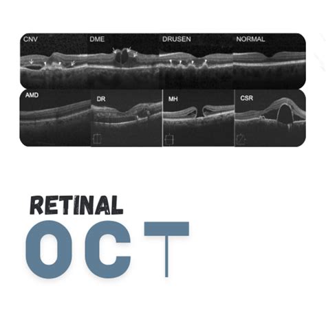 Retinal Oct Image Classification C8 Kaggle