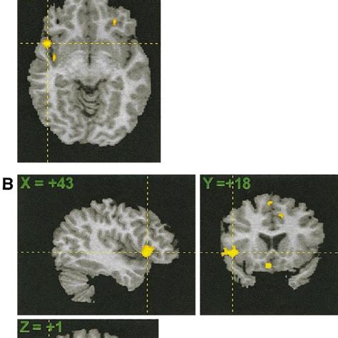 Slices Through The Insulaoperculum In Sagittal Transverse And