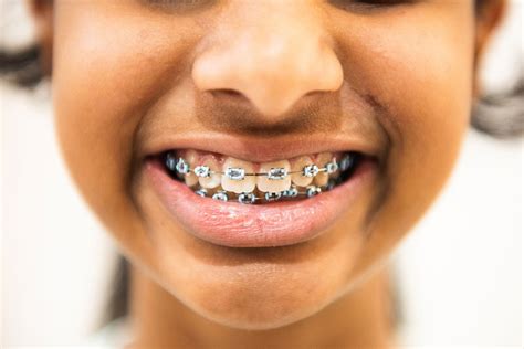 Braces Braces Sydney Ortho Co Parramatta And Canterbury