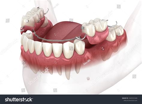 Removable Partial Denture Mandibular Prosthesis Medically Stock Illustration 1845531640