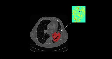 Predicting Immunotherapy Outcomes In Patients With Advanced Nsclc