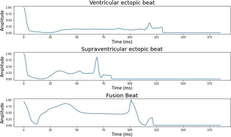 Cmc Free Full Text Classification Of Electrocardiogram Signals For