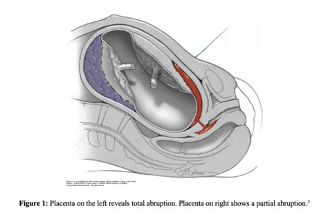 Placental Abruption Ultrasound