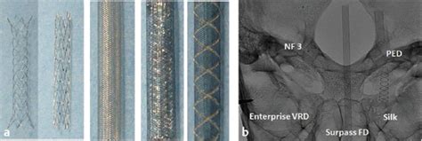 4 Coil Embolization Versus Flow Diversion Neupsy Key
