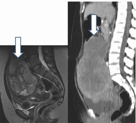 画像 heterogeneous lesion in uterus meaning What does a heterogeneous uterus mean