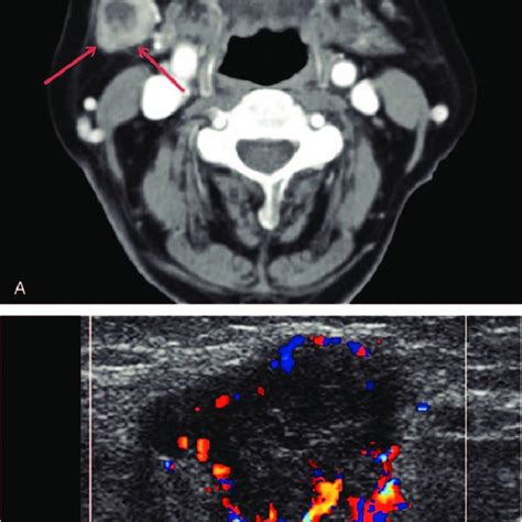 A A 44 Year Old Man Presented With A Palpable Preauricular Mass For 1