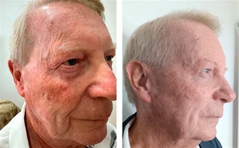 Exosomas Y Rosacea Exosomas Reference