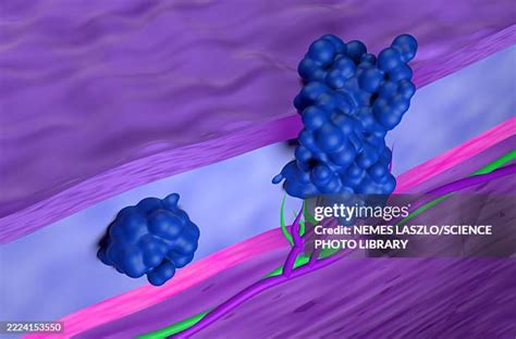 Benign And Malignant Tumours Illustraiton High Res Vector Graphic