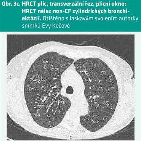 Pdf Non Cf Bronchiectasis Of Adults Short Review For Clinical Practice Position Paper Of