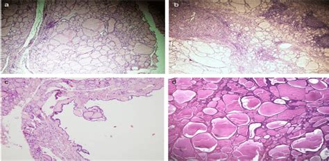 The Different Histological Types Of The Ectopic Thyroid And Normal