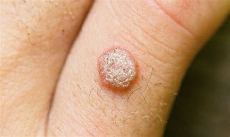 Hpv Warts Warts Removal On Face In Dubai Hpv Genital Warts Aed 249