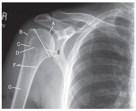 Shoulder X Ray Internal Vs External Rotation At Philip Cowell Blog