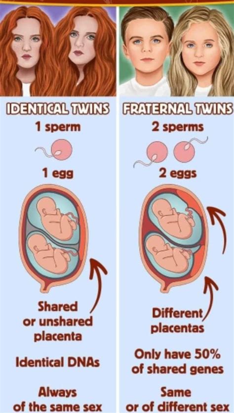 Twin To Twin Transfusion Syndrome Ttts Stages Diagnosis Artofit