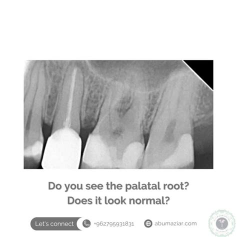 Video Hasan Abu Maizar On Linkedin Rootcanaltreatment Root